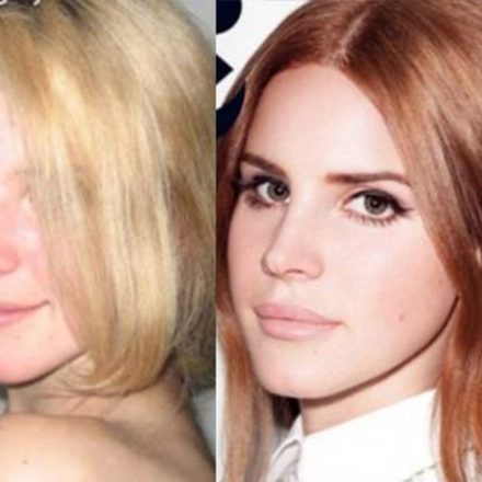 Could this be the case with Lana Del Rey plastic surgery?