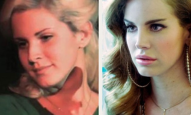 Could this be the case with Lana Del Rey plastic surgery?