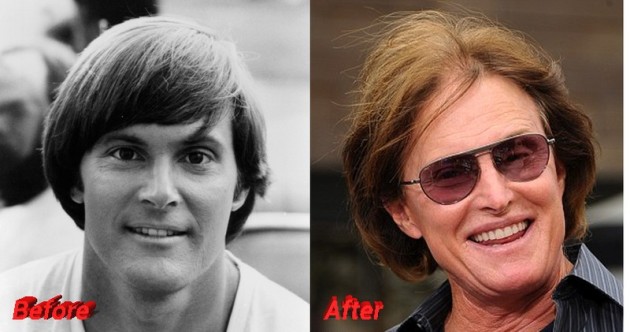 Bruce Jenner Plastic Surgery: From Male Athlete to Female Star