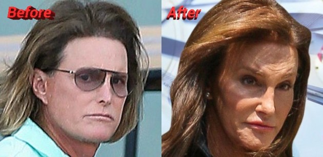 Bruce Jenner Plastic Surgery: From Male Athlete to Female Star