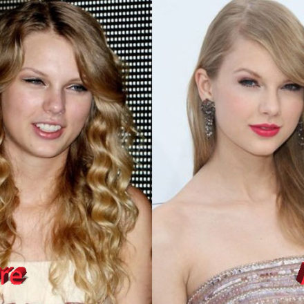 Taylor Swift Plastic Surgery Before and After
