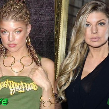 Fergie Plastic Surgery Before and After Review