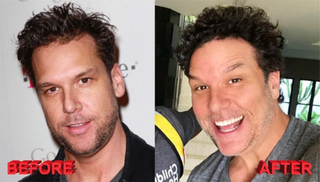 Dane Cook Plastic Surgery - Before and After Photos - Celebrity Plastic ...